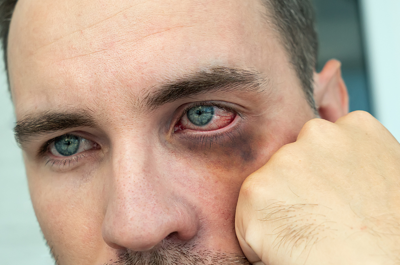 Orbital Fracture Repair Surgery | American Eye Associates